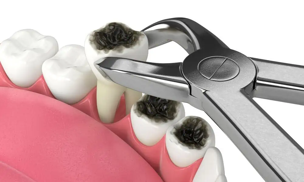 Can Your Tooth Get Infected After Years Of Root Canal Treatment - Watty ...